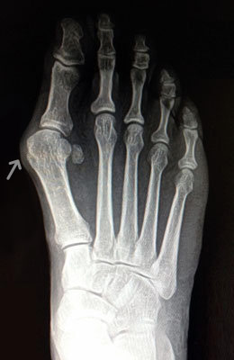 Toe Correction Surgery - Before and After Pictures