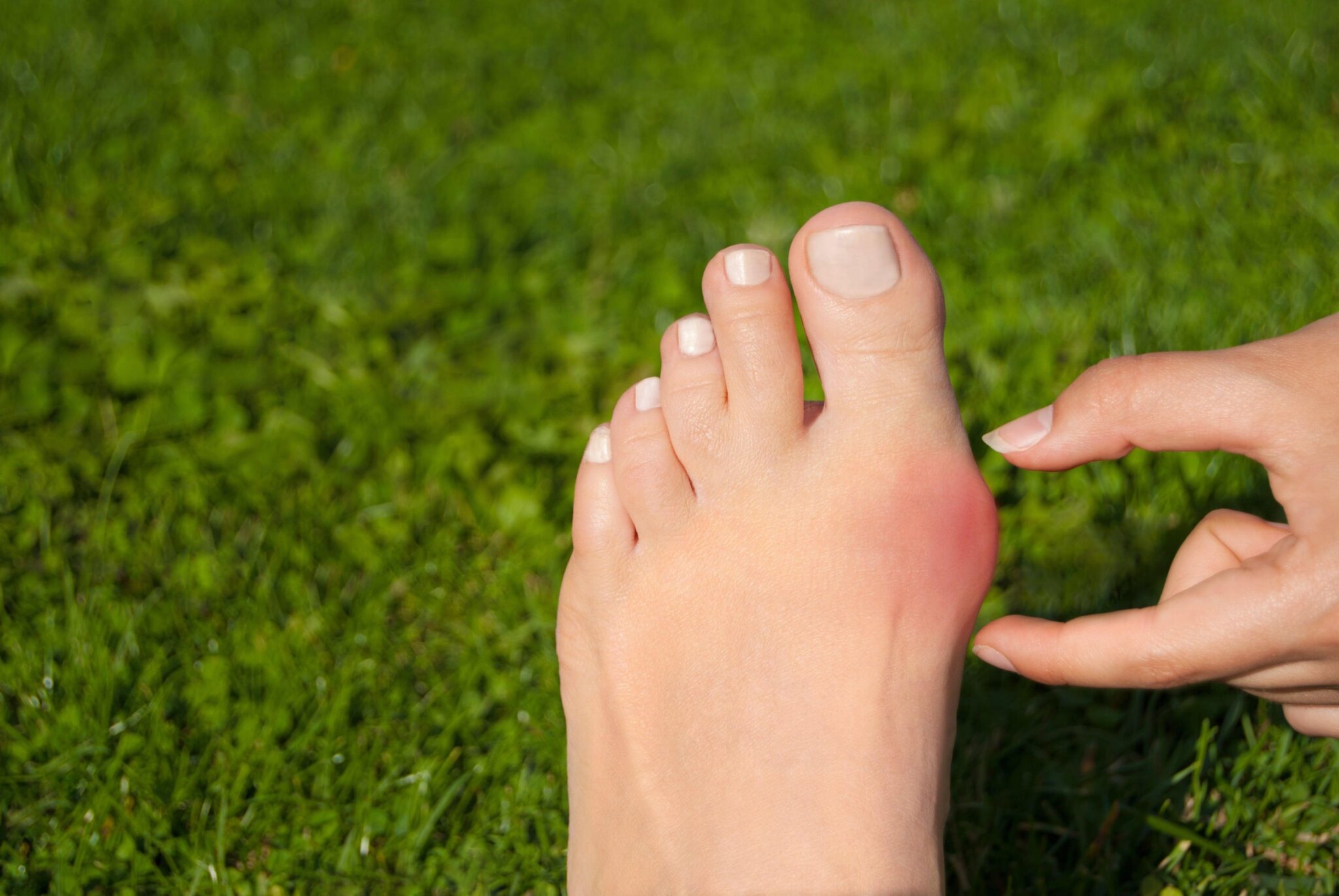 Bunion Treatment - The Foot Doctors of Santa Cruz County | Santa Cruz ...