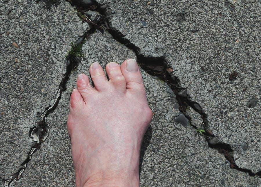 Hammertoe Deformity Treatment in Folsom, Roseville & Carmichael ...
