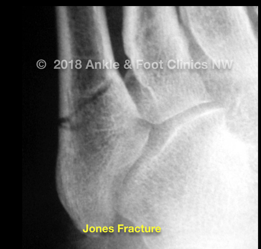 Jones Fracture | Integrative Foot & Ankle Centers of Washington
