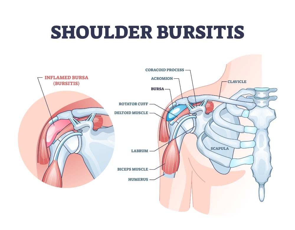 Shoulder Bursitis | Premier Podiatry & Orthopedics | Serving Roseville ...