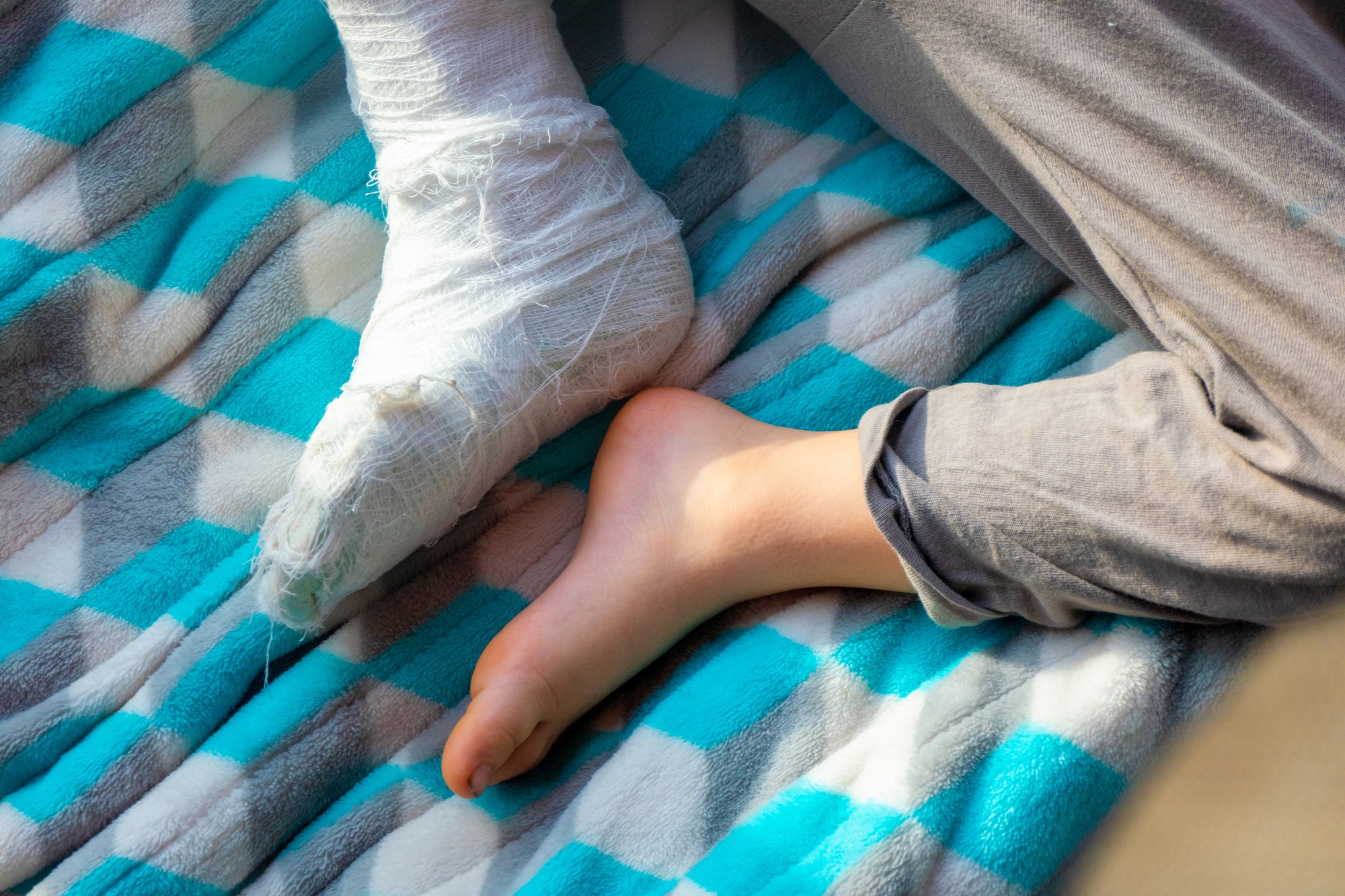 Calcaneal Apophysitis - Sever’s Disease | Treatment Options