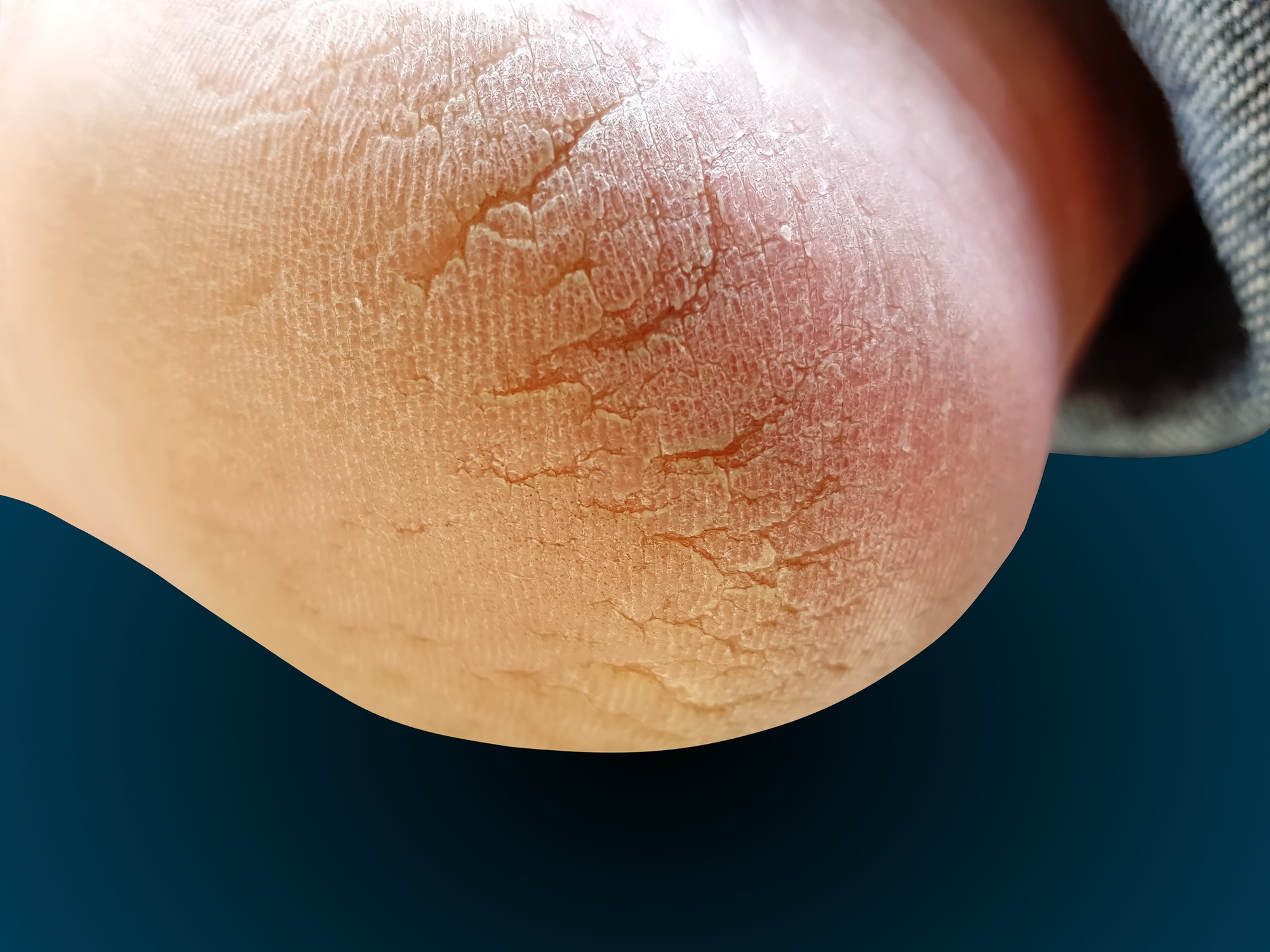 Cracks and Fissures | Foot and Ankle Specialists